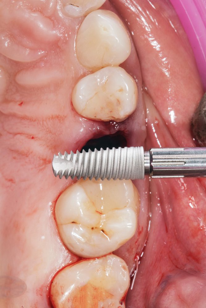 ΑΜΕΣΗ ΤΟΠΟΘΕΤΗΣΗ ΕΜΦΥΤΕΥΜΑΤΩΝ - SkyDental